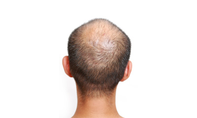 If a person has stage 3 male pattern baldness with diffuse hair loss ...