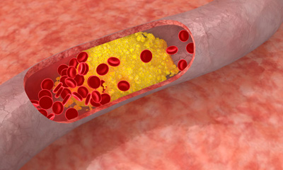 Total cholesterol level is 265 LDL is 206. Rest are normal Which ...
