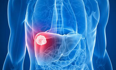 My liver is enlarged. Its 16.8 cm. Does enlarged liver is also fatty ...