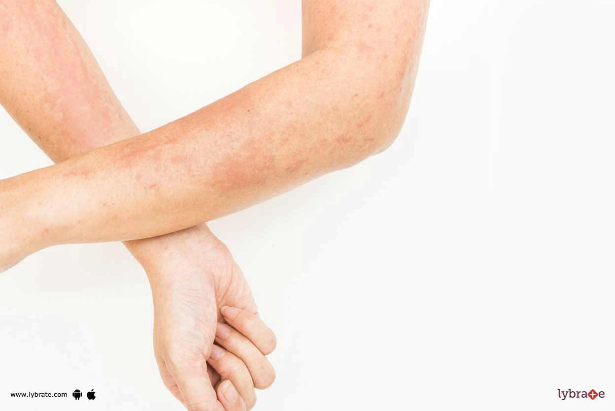 Protein Contact Dermatitis - How To Detect It? - By Dr. Sumit Sharma ...