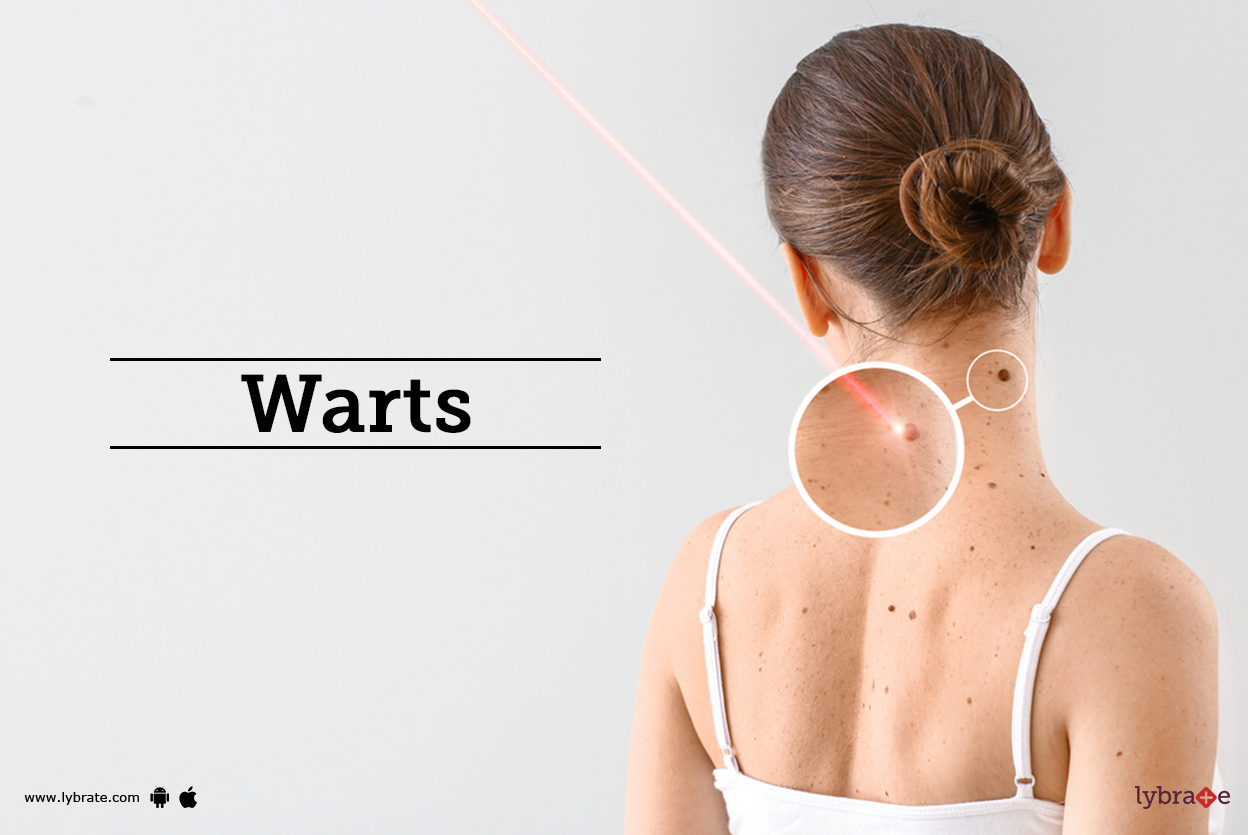 Warts - By Dr. Jitendra Gedam | Lybrate