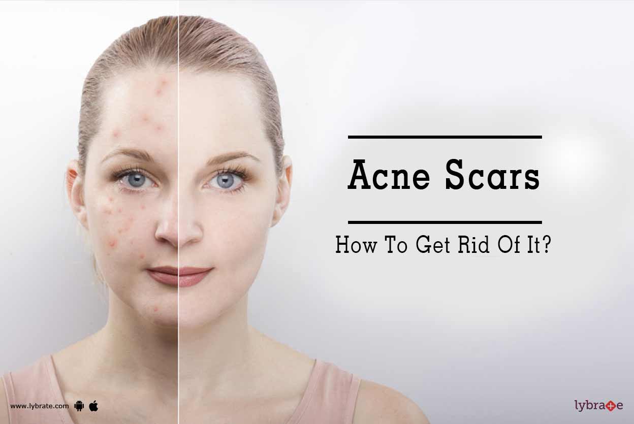 Acne Scars - How To Get Rid Of It? - By Dr. Ramneek Kaur | Lybrate