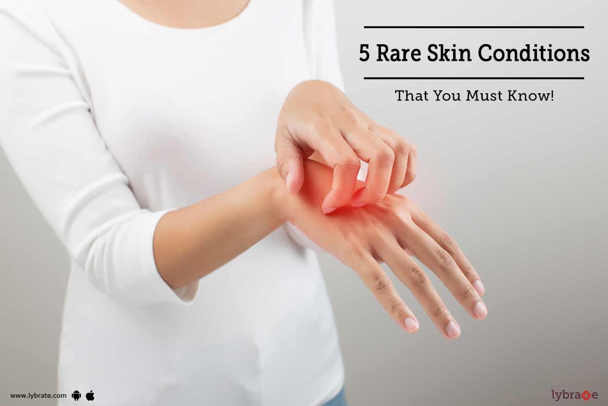 5 Rare Skin Conditions That You Must Know! - By Dr. A K Singh | Lybrate
