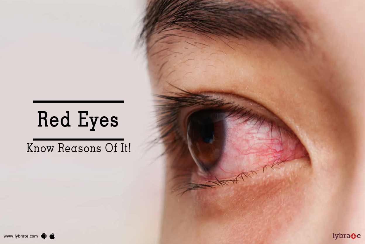 Red Eyes - Know Reasons Of It! - By Dr. Kartikeya Sangal | Lybrate