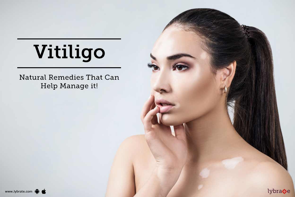 Vitiligo - Natural Remedies That Can Help Manage it! - By Dr. Elizabath ...
