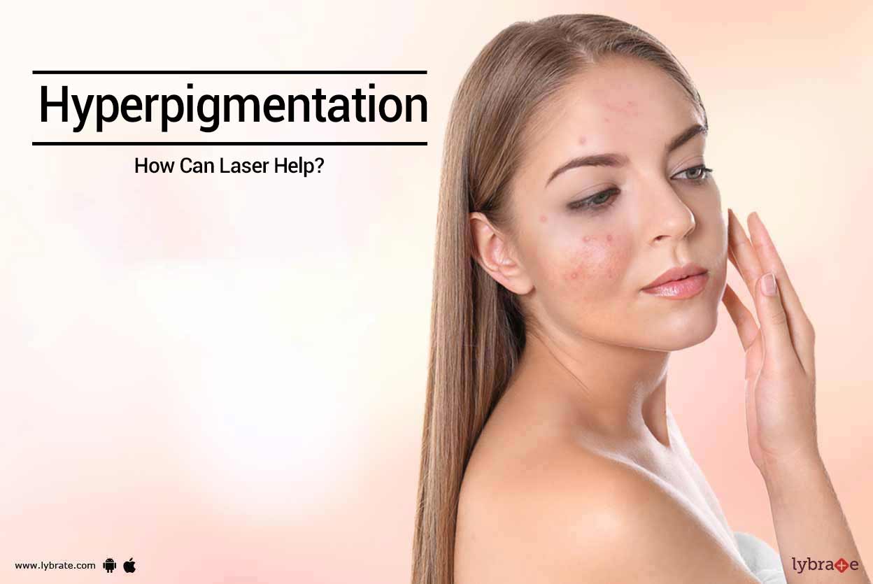 Hyperpigmentation - How Can Laser Help? - By Dr. Rachna Singh | Lybrate