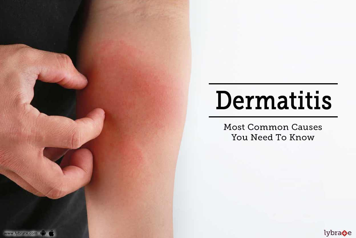 Dermatitis: Most Common Causes You Need To Know - By Dr. Mool Chand ...