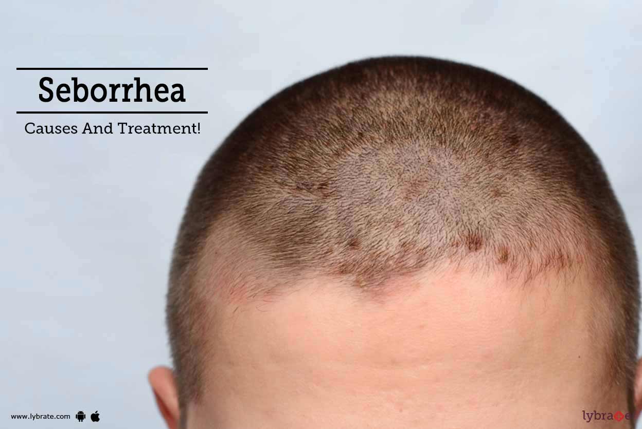 Seborrhea - Causes And Treatment! - By Dr. Brinda David | Lybrate