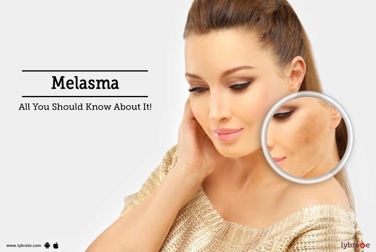 Melasma - All You Should Know About It! - By Dr. Neeharika Manchanda ...