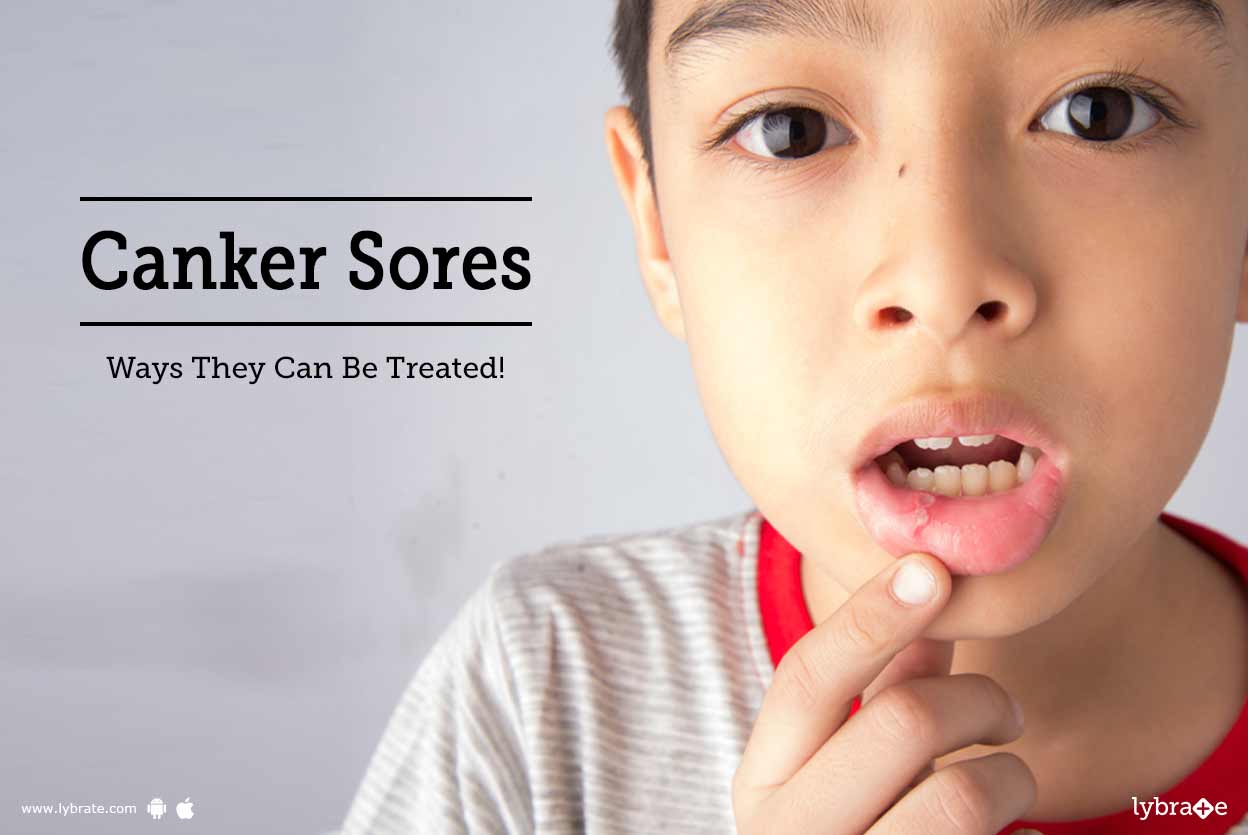 Canker Sores - Ways They Can Be Treated! - By Dr. Jagatjit Singh Kohli ...