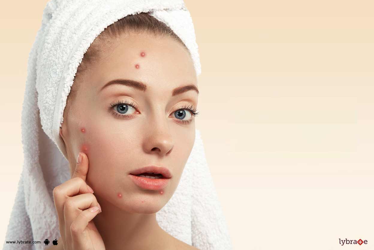 Acne Scar - Know Ways Of Tackling Them! - By Dermis Skin & Hair Clinic ...