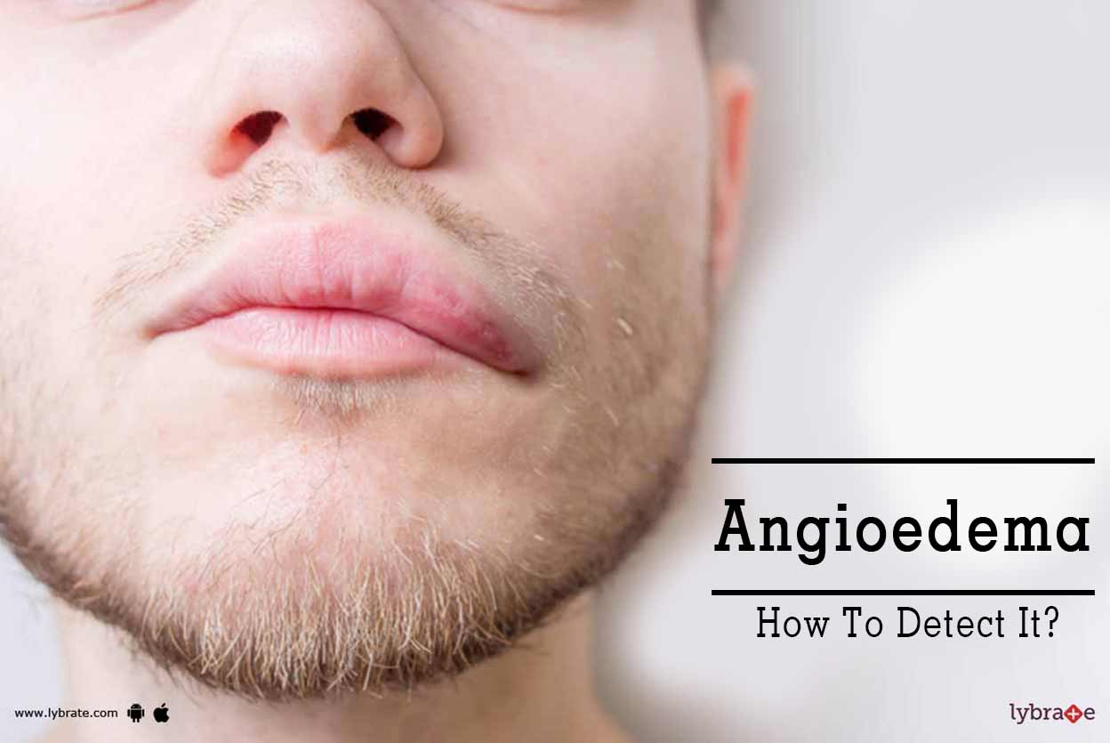 Angioedema - How To Detect It? - By Dr. Amarendra Pandey | Lybrate