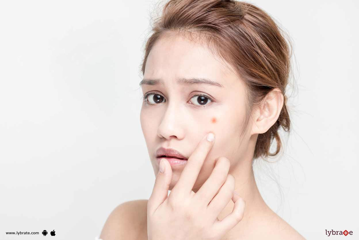 Acne & Pimples - Know Homeopathic Treatment For It! - By Dr. Kamlesh ...