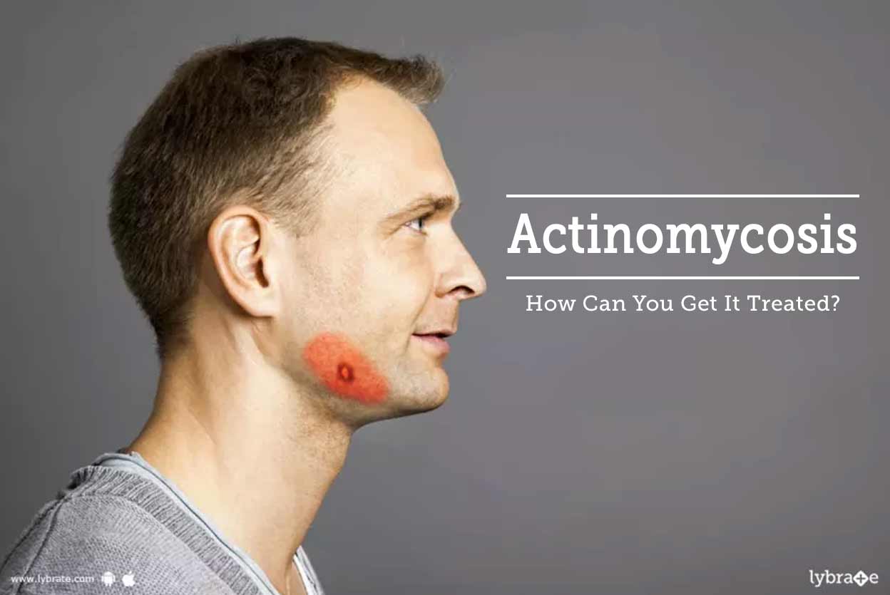 Actinomycosis - How Can You Get It Treated? - By Dr. Ganesh Avhad | Lybrate
