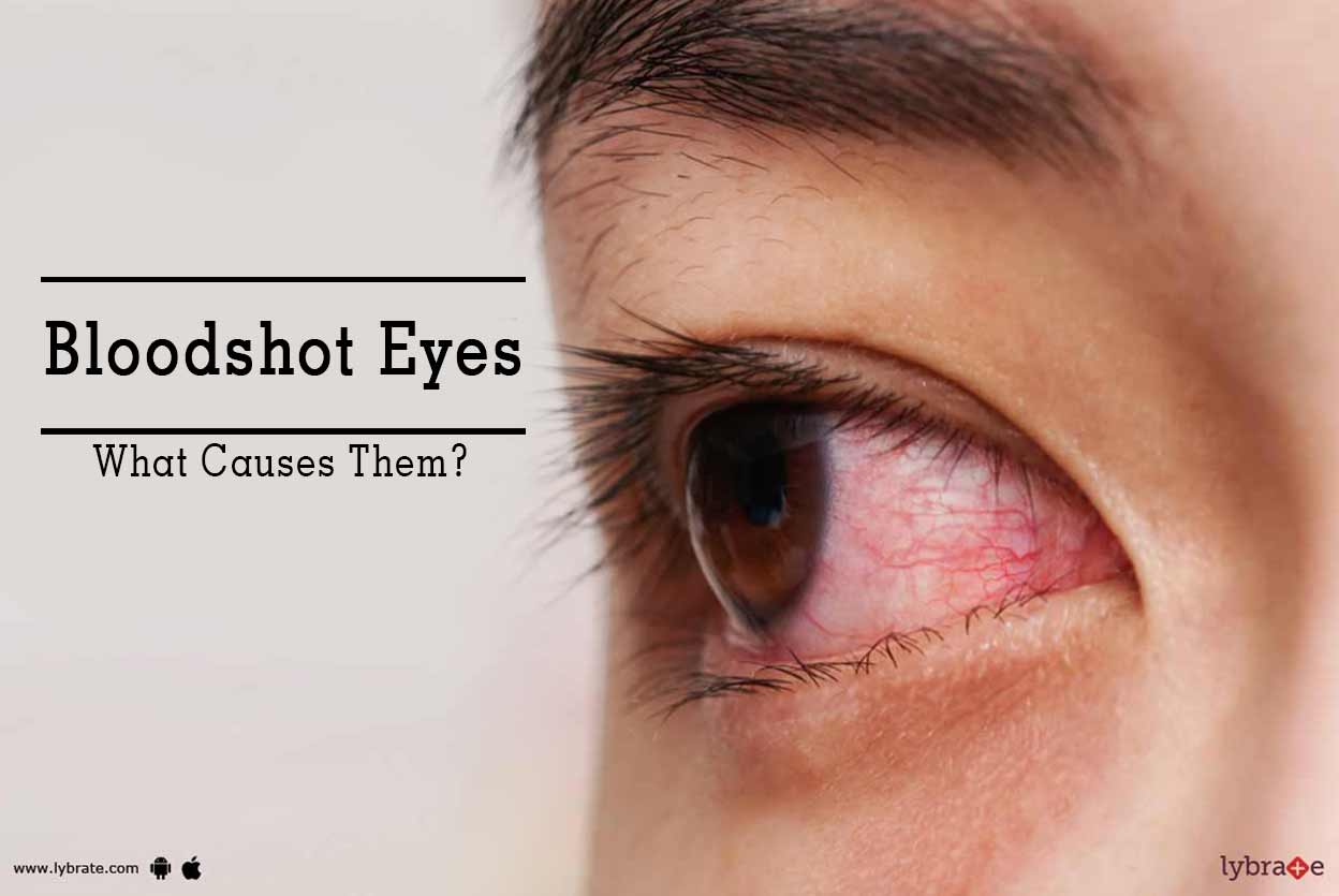 Bloodshot Eyes - What Causes Them? - By Dr. Anurag Agarwal | Lybrate