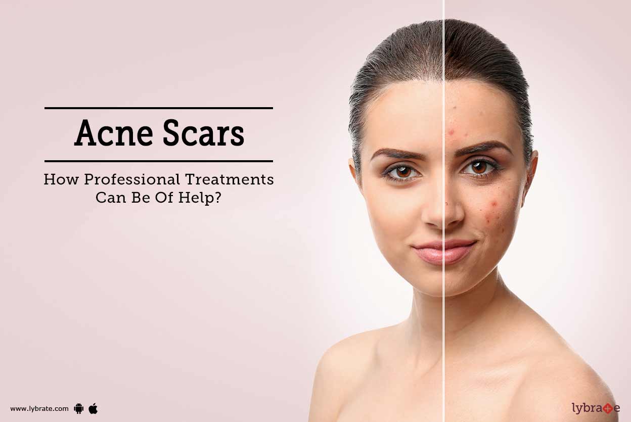 Acne Scars - How Professional Treatments Can Be Of Help? - By Dr ...