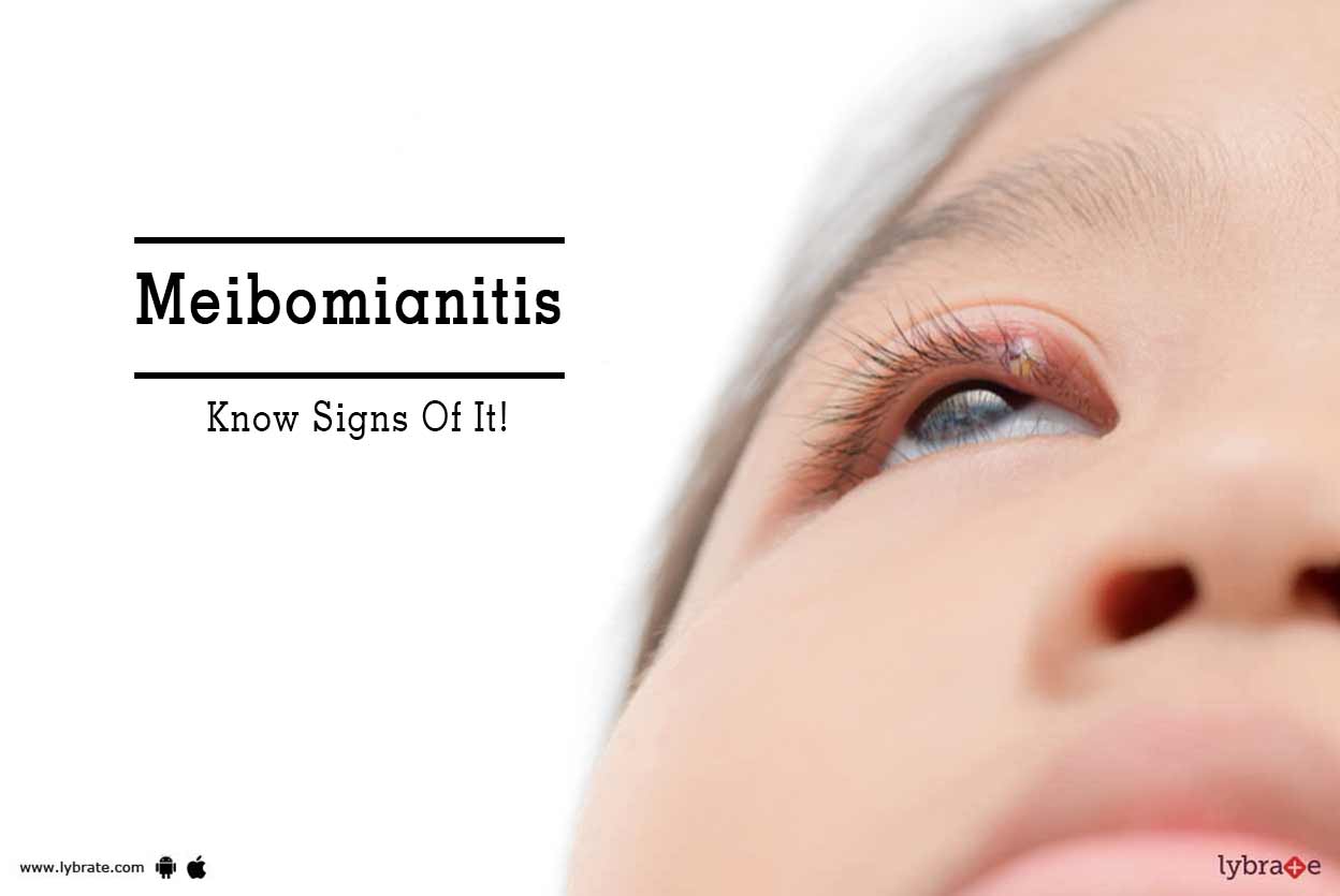 Meibomianitis - Know Signs Of It! - By Dr. Anurag Agarwal | Lybrate