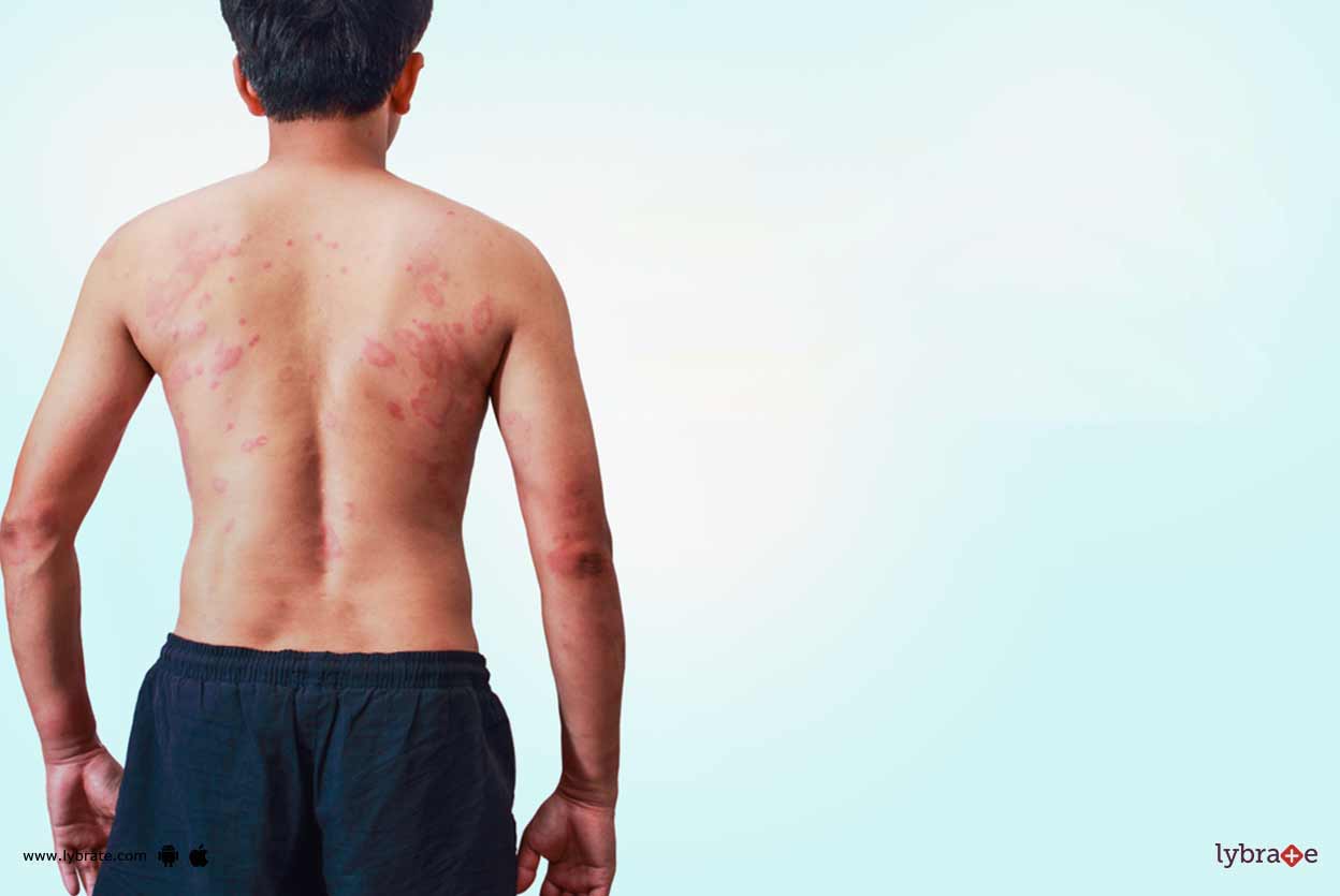 What Is A Drug Eruption Rash? - By Tender Skin International | Lybrate