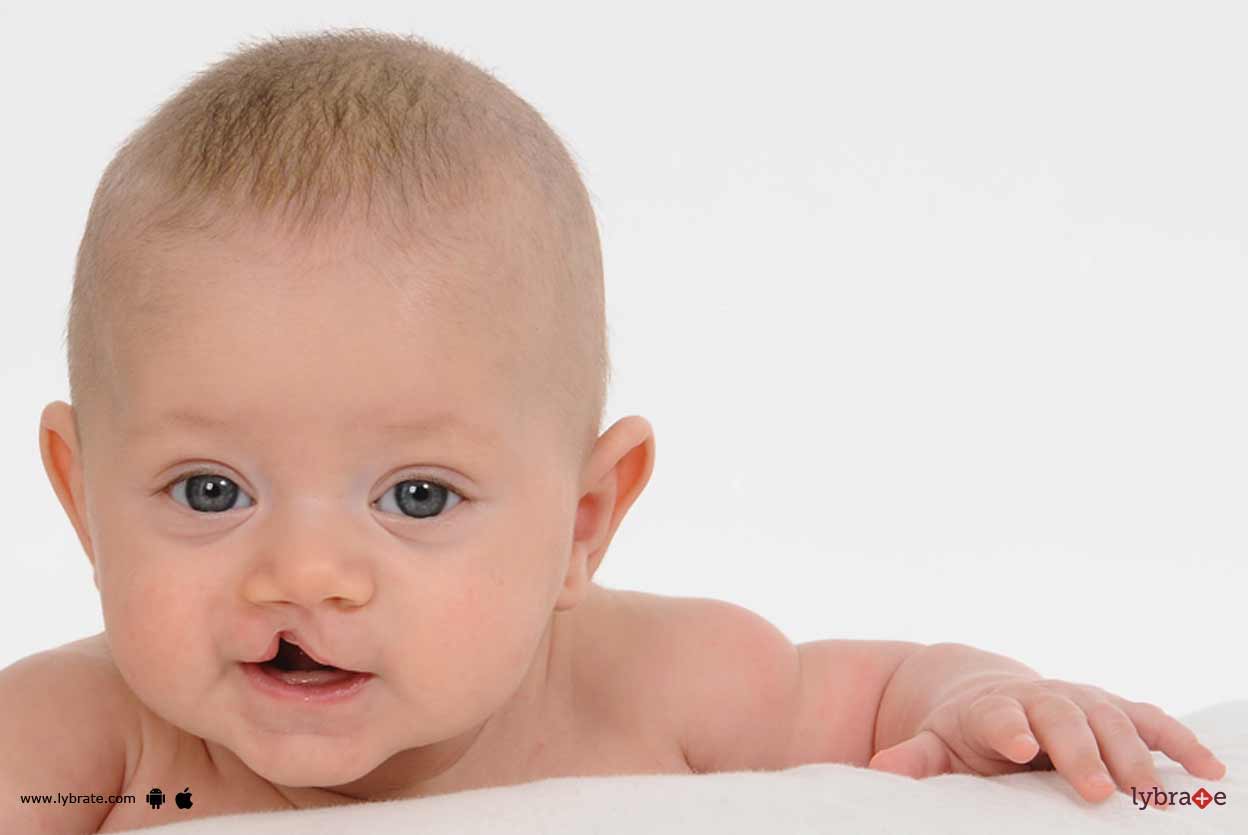 Cleft Palate - Know Risks Of It! - By Dr. Manohar L Dawan | Lybrate
