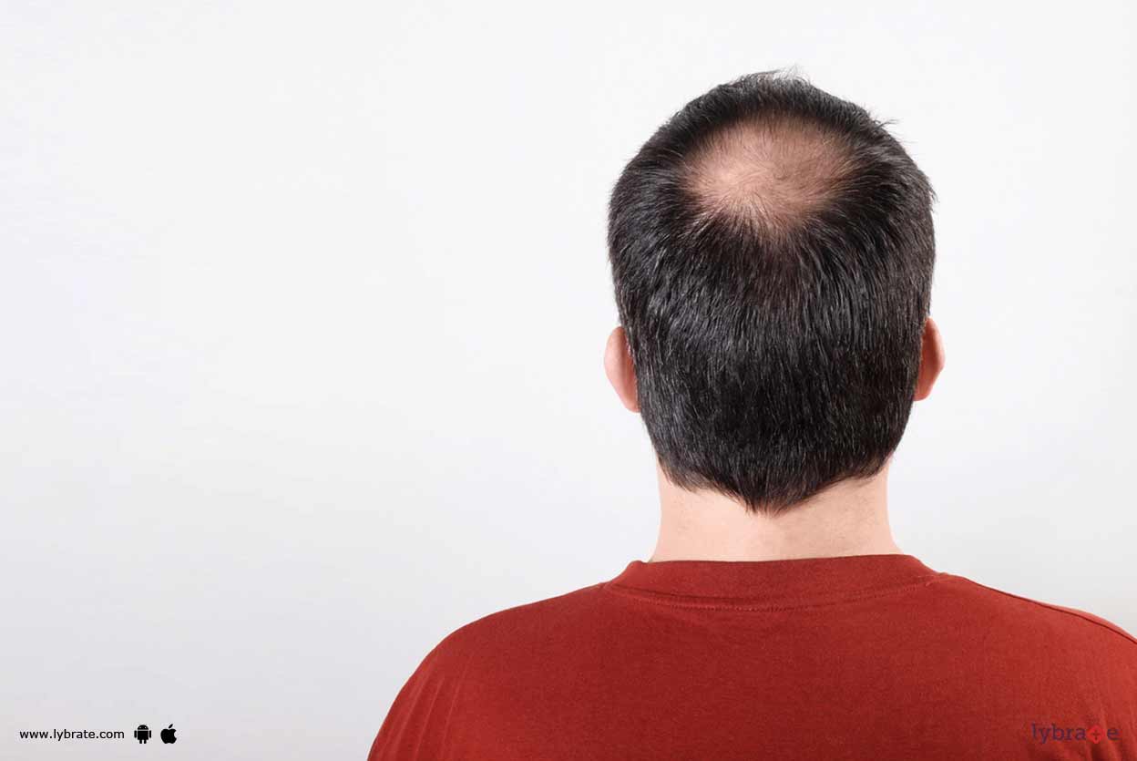 Male Or Female Pattern Baldness - What Should You Know? - By Dr. Ankuja ...