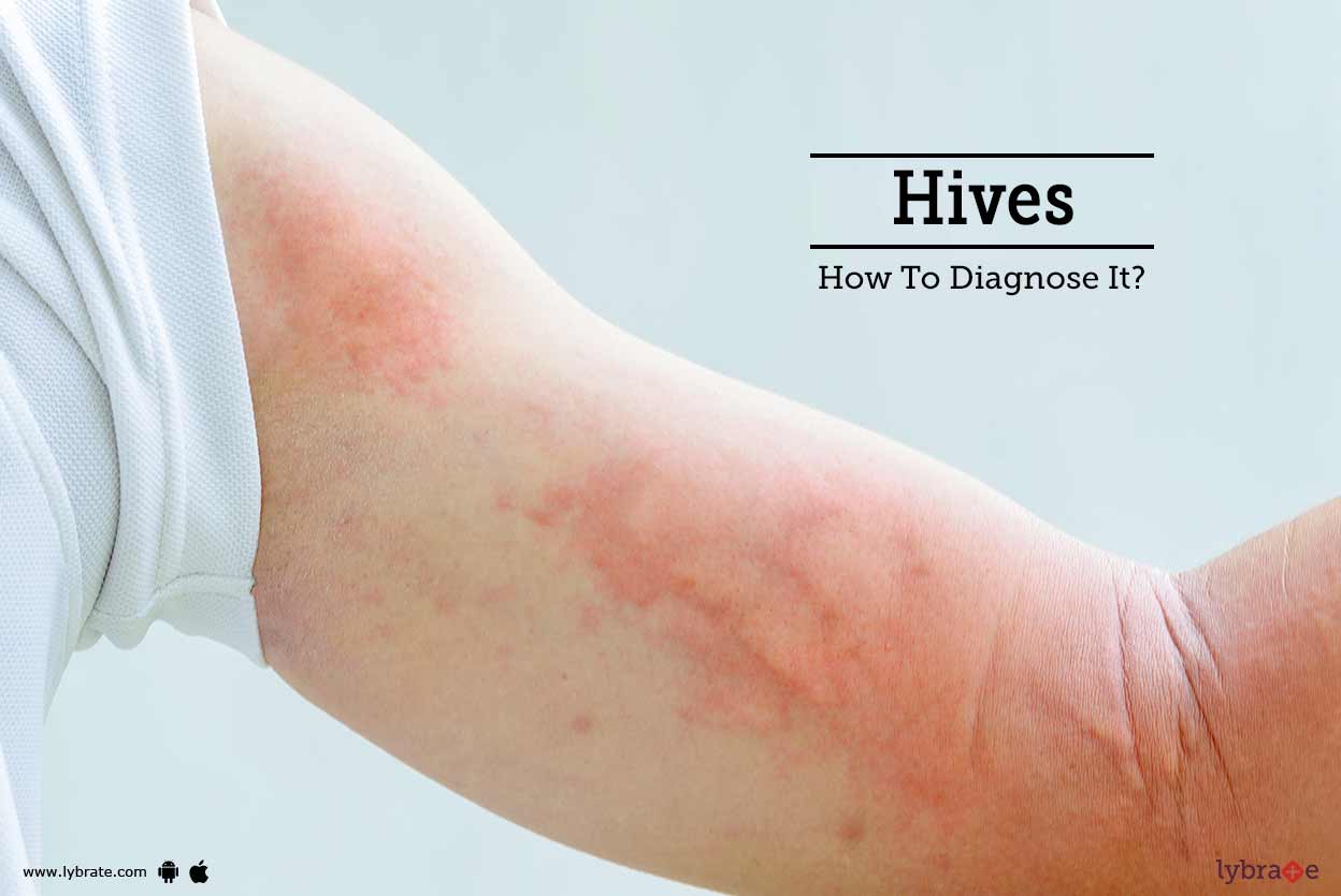 Hives - How To Diagnose It? - By Dr. Malay Mehta | Lybrate