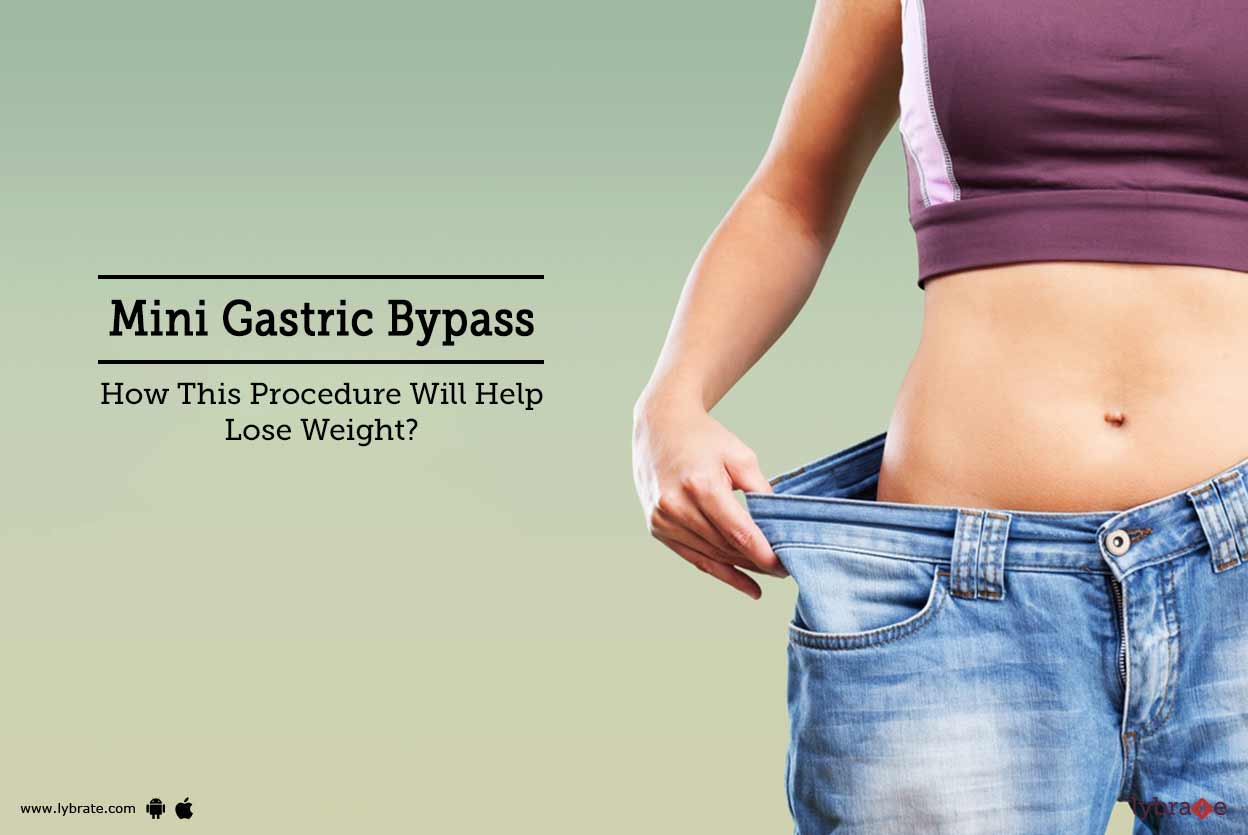 Mini Gastric Bypass - How This Procedure Will Help Lose Weight? - By A ...