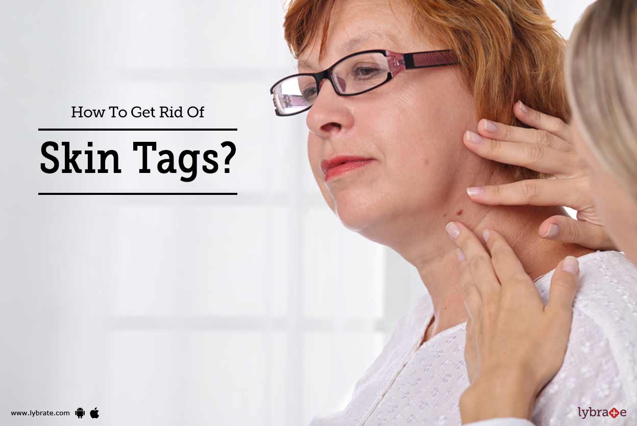 How To Get Rid Of Skin Tags? - By Dr. Himanshu Singhal | Lybrate