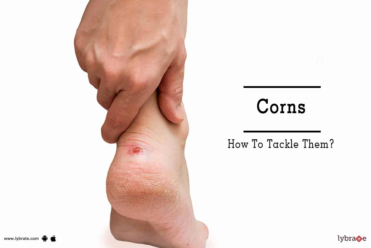 Corns - How To Tackle Them? - By Dr. B Lakshmi Divya | Lybrate