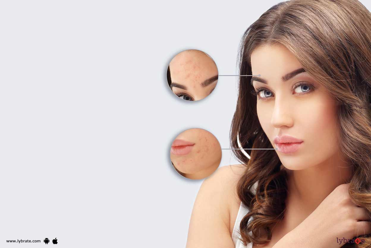 Acne & Blemishes - 6 Natural Remedies That Can Help! - By Dr. Suneet V ...