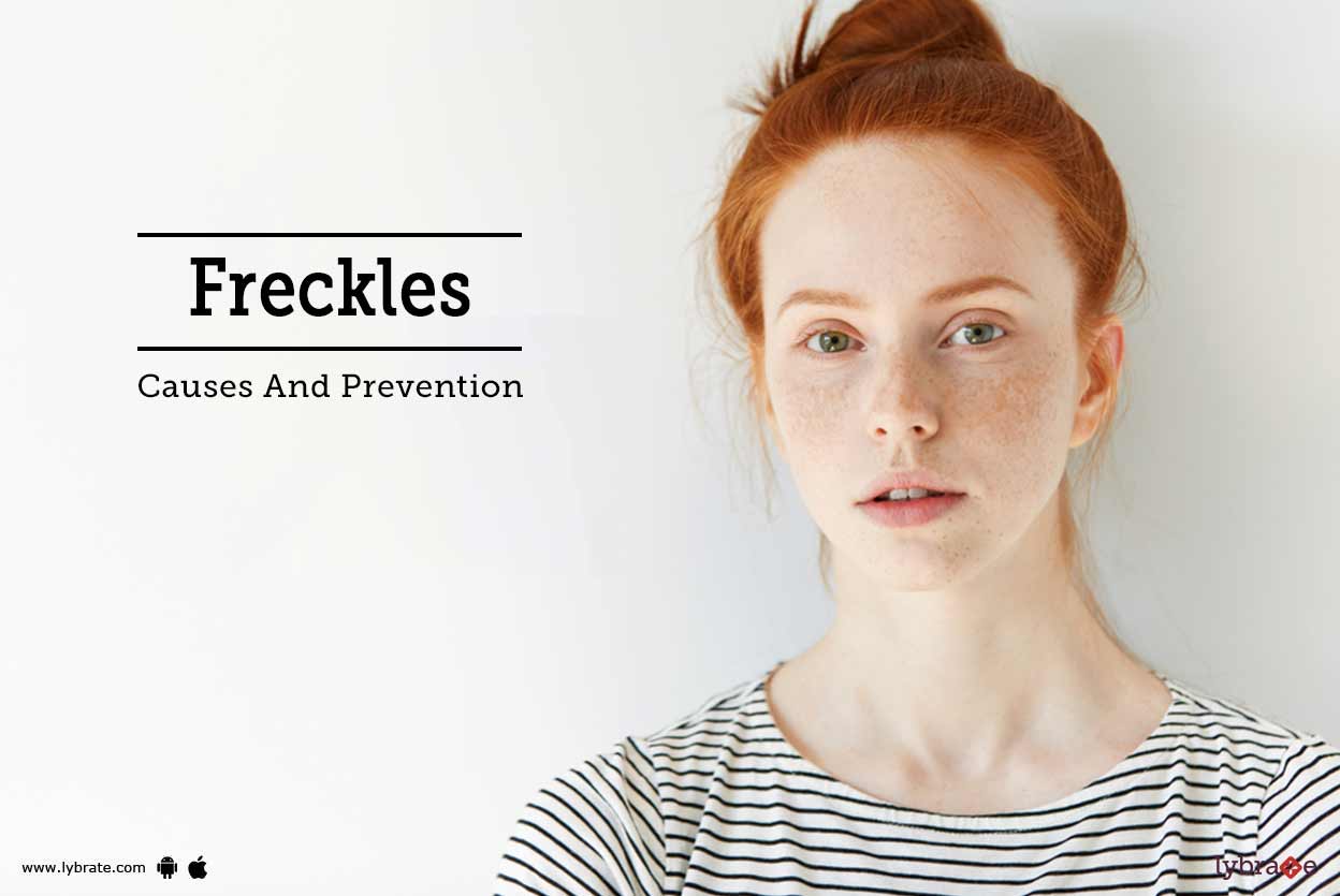 Freckles - Causes And Prevention - By Dr. Vinay Singh | Lybrate