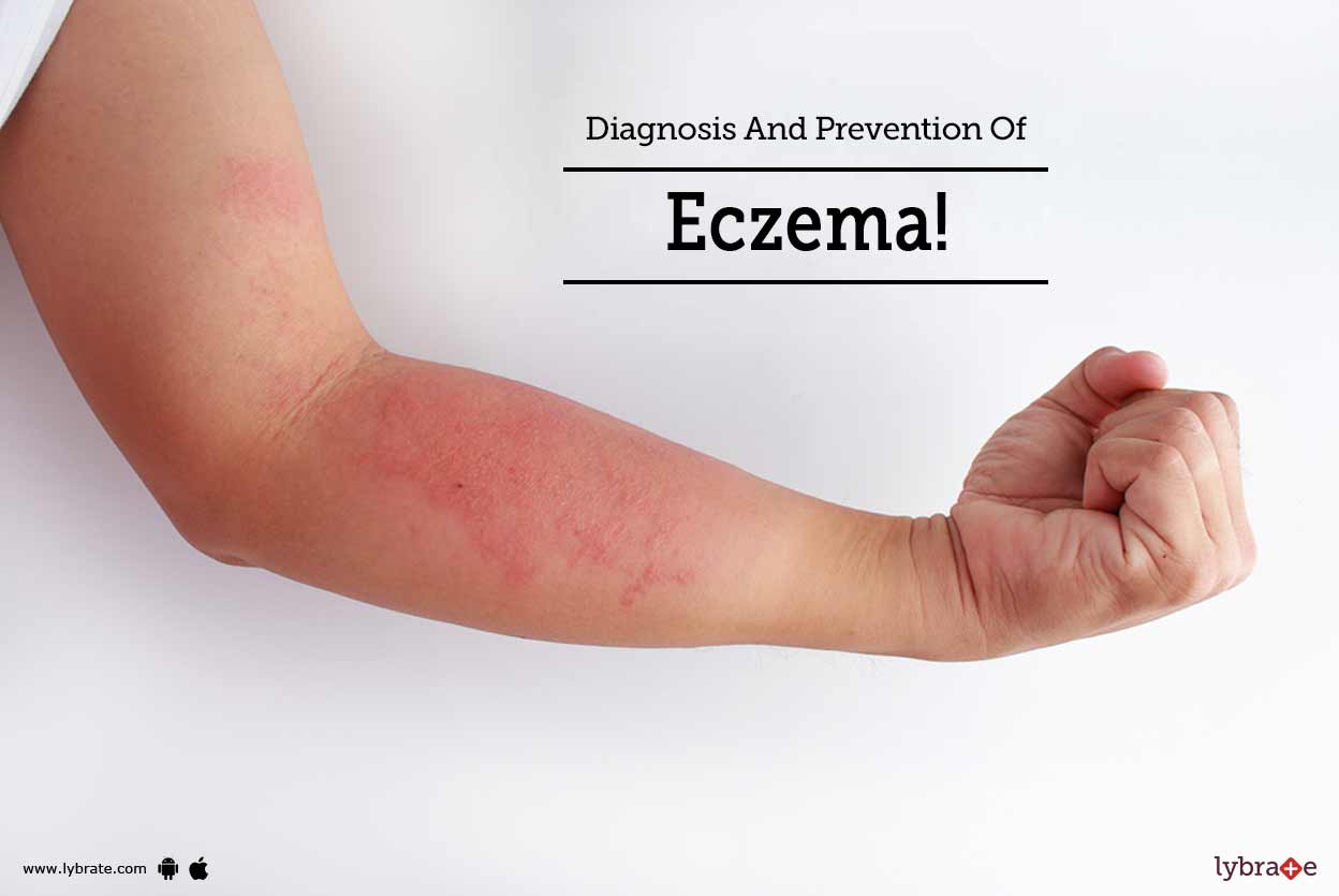 Diagnosis And Prevention Of Eczema! - By Dr. Brinda David | Lybrate