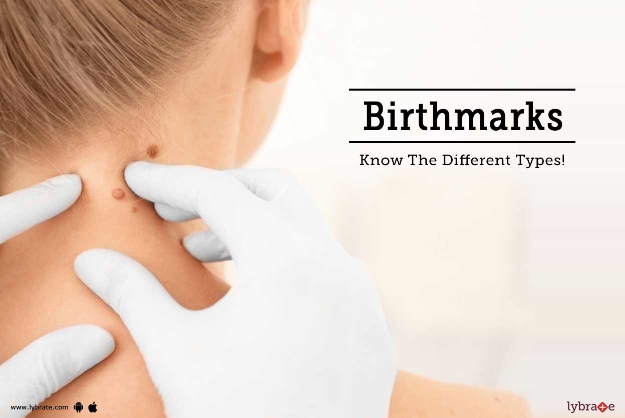 Birthmarks - Know The Different Types! - By Dr. Shaurya Rohatgi | Lybrate