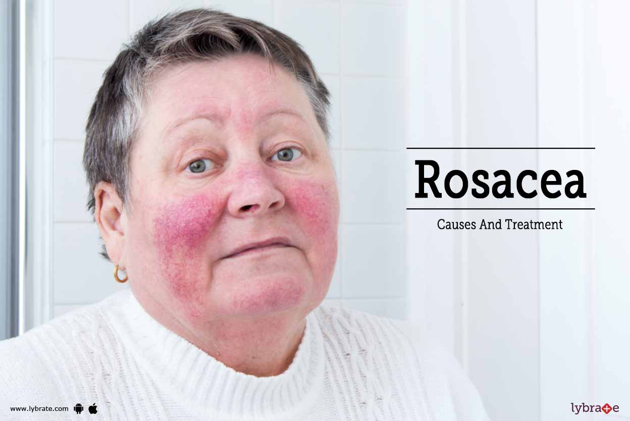 Rosacea - Causes And Treatment - By Dr. Sushma Yadav | Lybrate