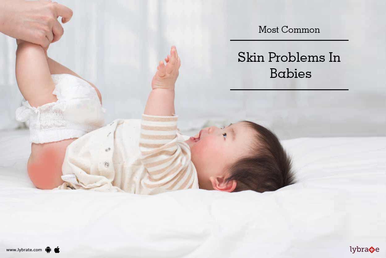 Most Common Skin Problems In Babies - By Dr. A K Singh | Lybrate