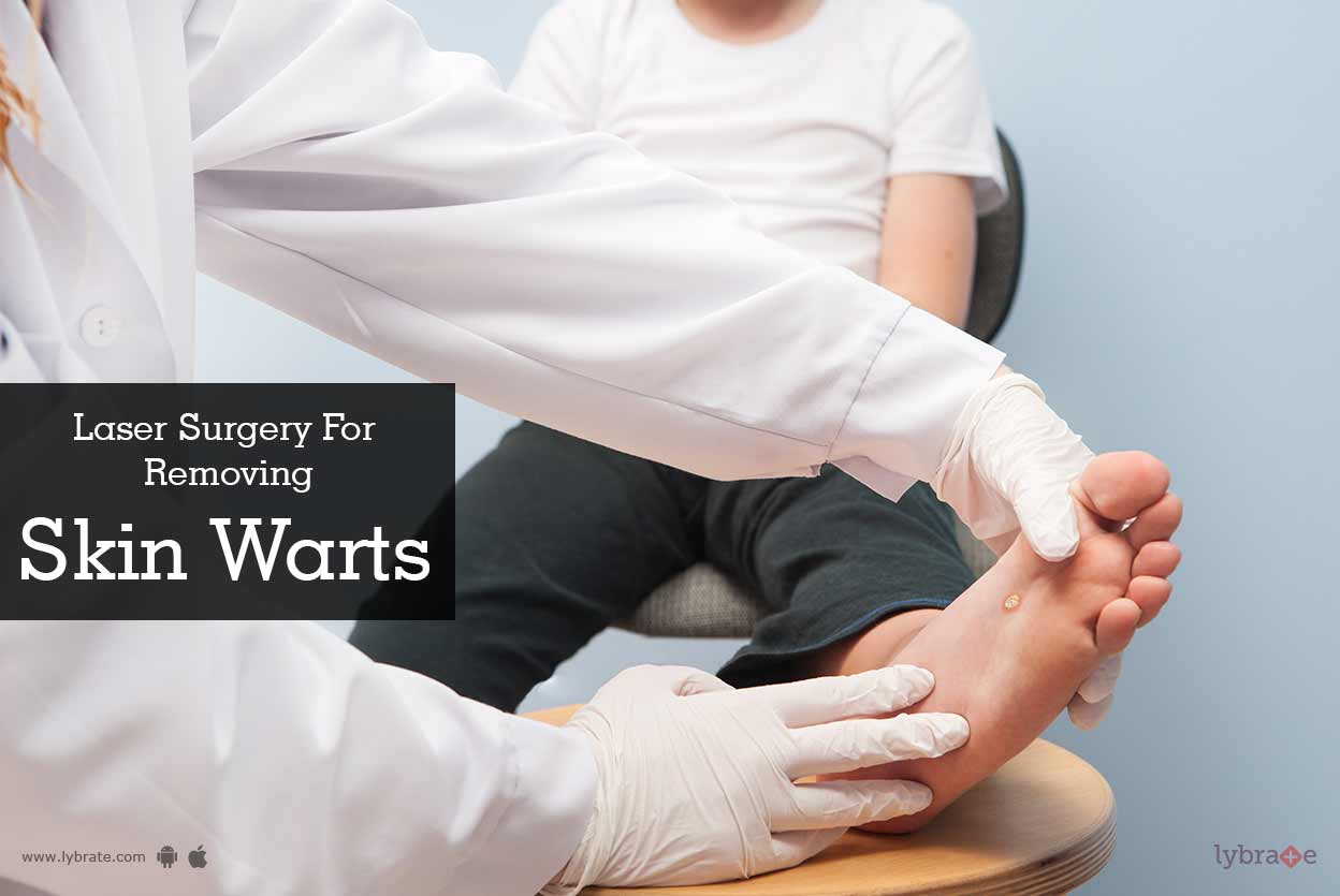 Laser Surgery for Removing Skin Warts - By Dr. Rohit Goel | Lybrate