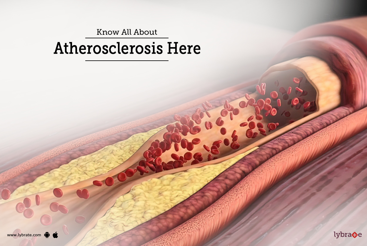Know All About Atherosclerosis Here - By Dr. Garima | Lybrate