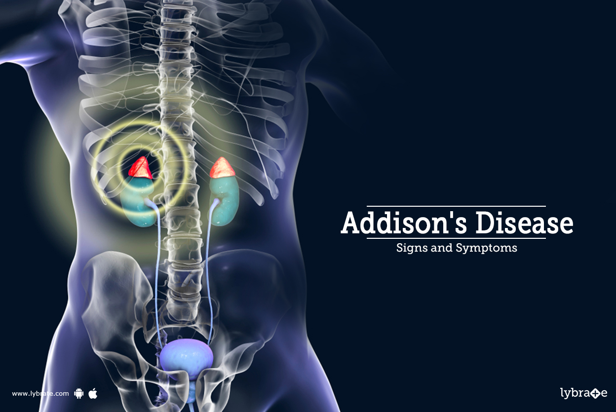 Addison's Disease- Signs and Symptoms - By Dr. Radhika Amulraj | Lybrate