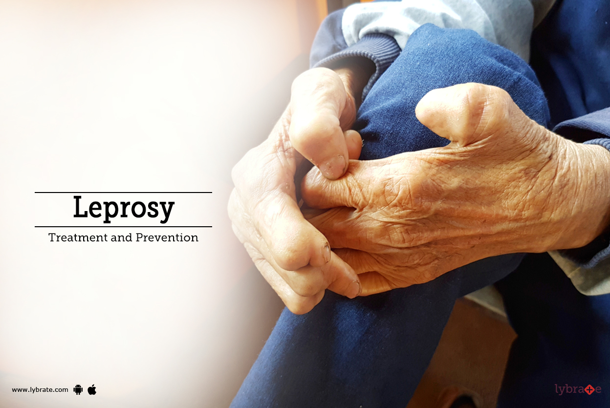 Leprosy- Treatment, and Prevention - By Dr. (Col.)Anil Goyal | Lybrate