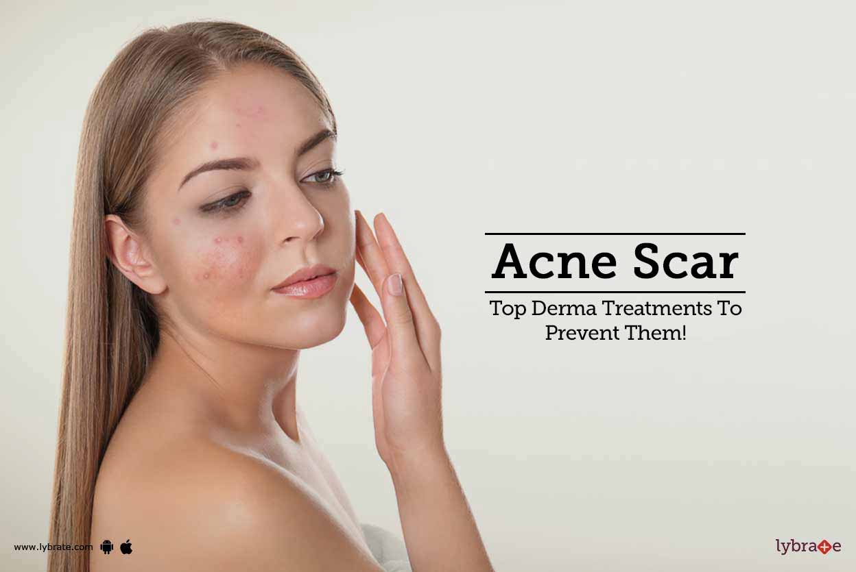 Acne Scar - Top Derma Treatments To Prevent Them! - By Dr. Bhavuk ...
