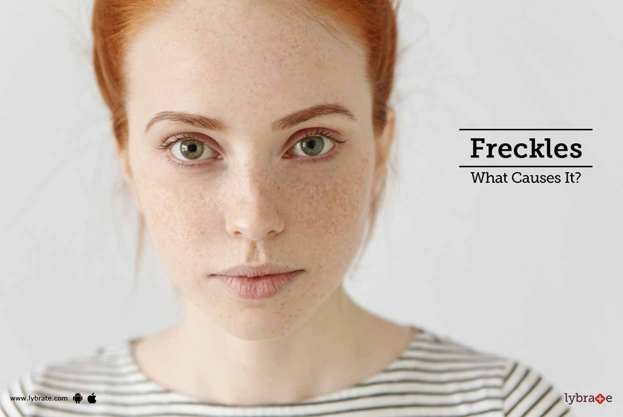 Freckles - What Causes It? - By Dr. Tarun Mittal | Lybrate