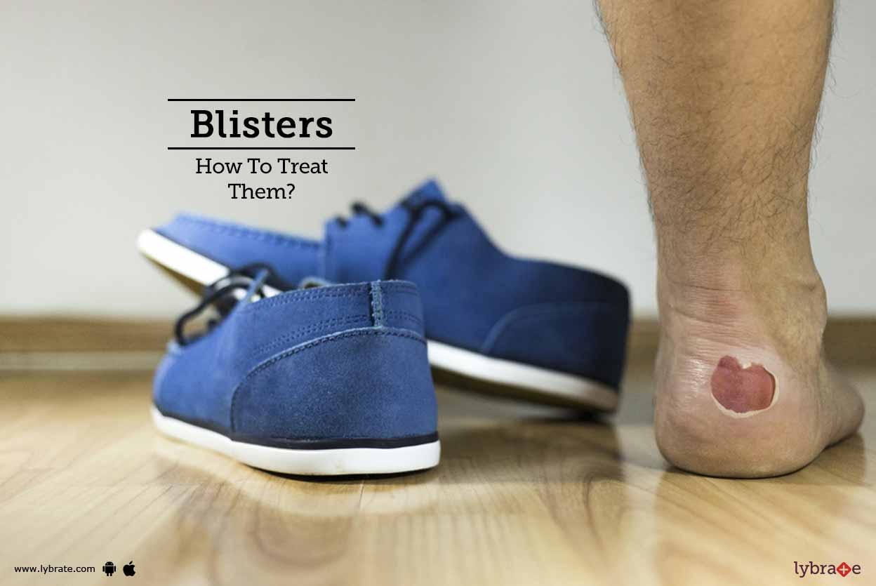 Blisters - How To Treat Them? - By Dr. Sajeev Kumar | Lybrate
