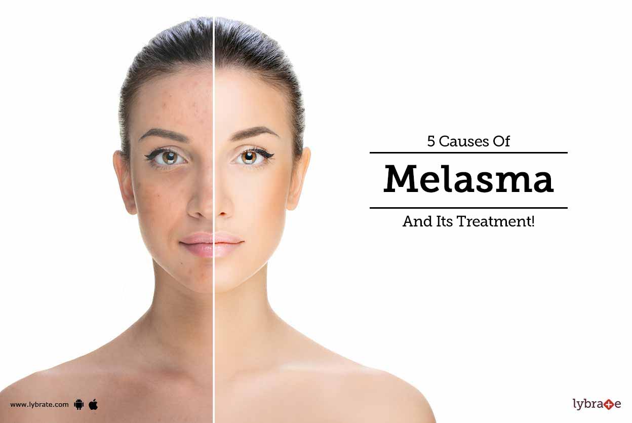 5 Causes Of Melasma And Its Treatment! - By Sakhiya Skin Clinic Private ...