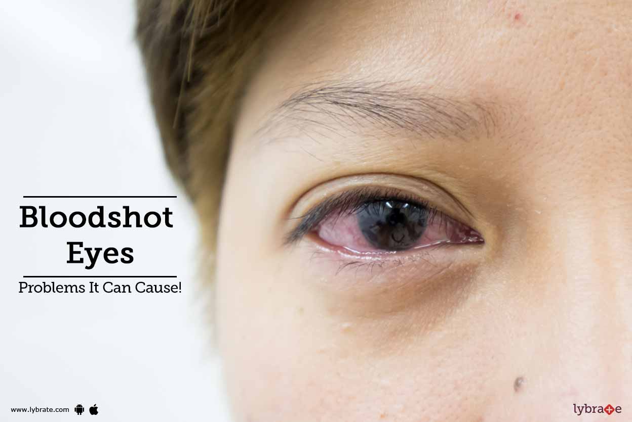 Bloodshot Eyes - Problems It Can Cause! - By Dr. Ruchi | Lybrate