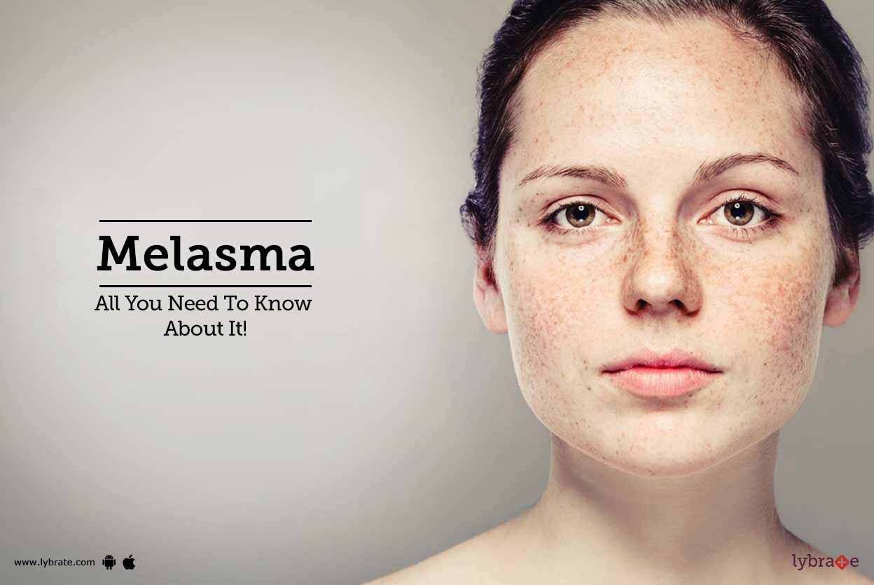 Melasma - All You Need To Know About It! - By Dr. Vidula Kamath | Lybrate