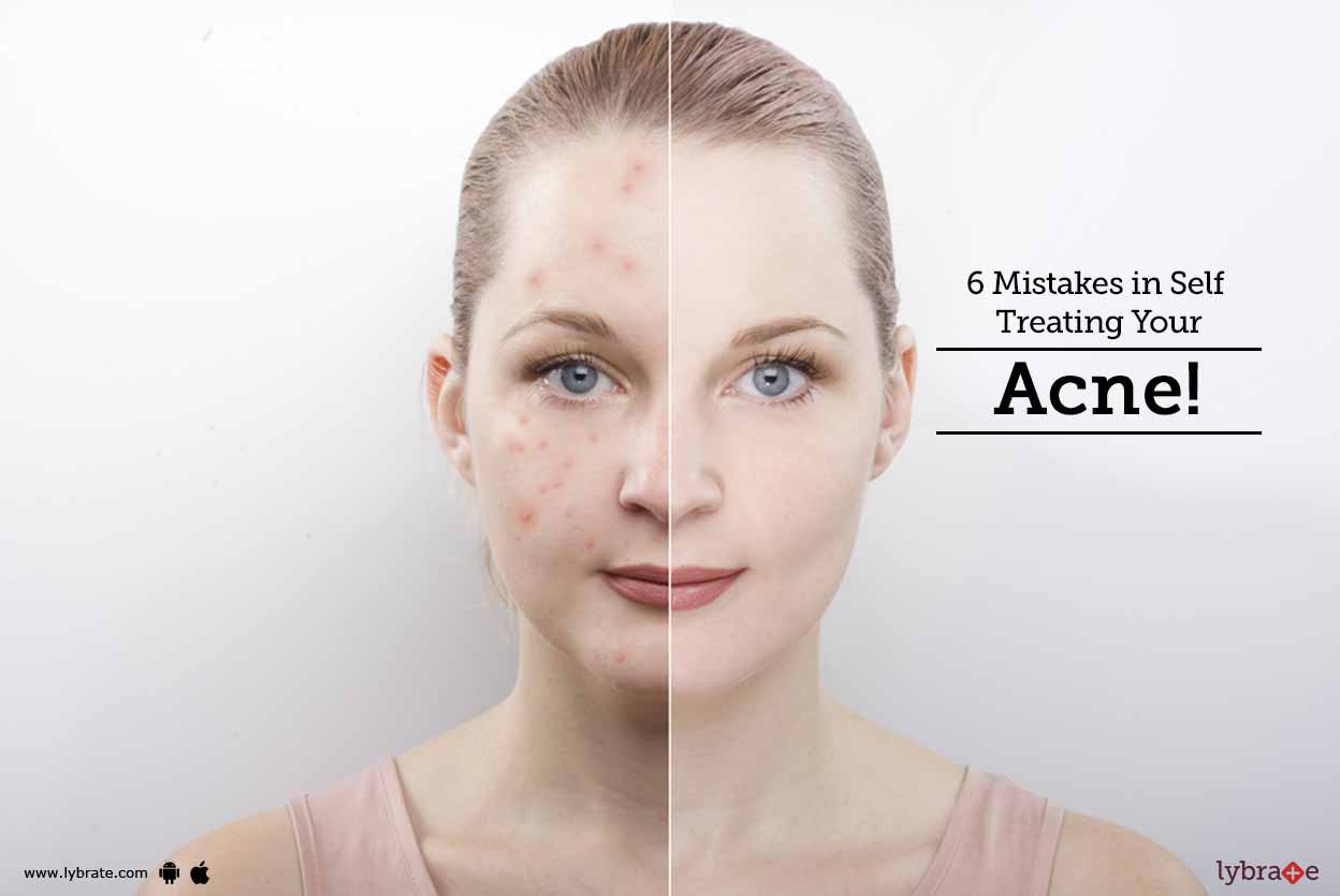 6 Mistakes in Self-Treating Your Acne! - By Dr. Ashvith Shetty | Lybrate