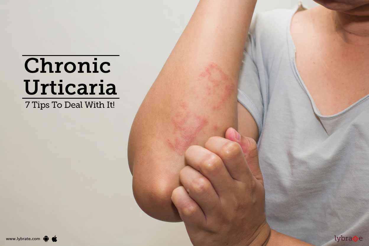 Chronic Urticaria 7 Tips To Deal With It By Dr Laxman Besra Lybrate