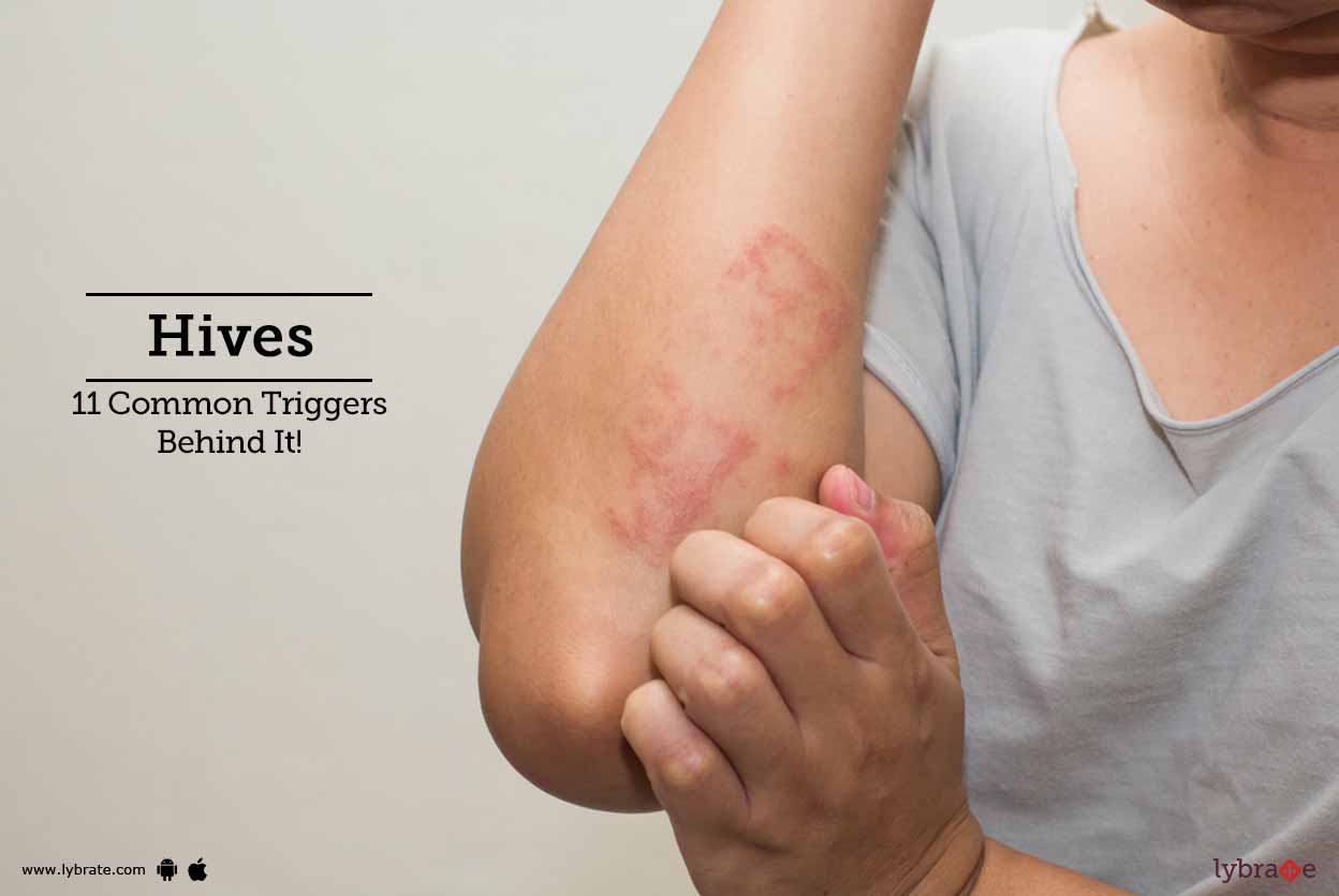 Hives - 11 Common Triggers Behind It! - By Zion Aesthetics Skin And ...
