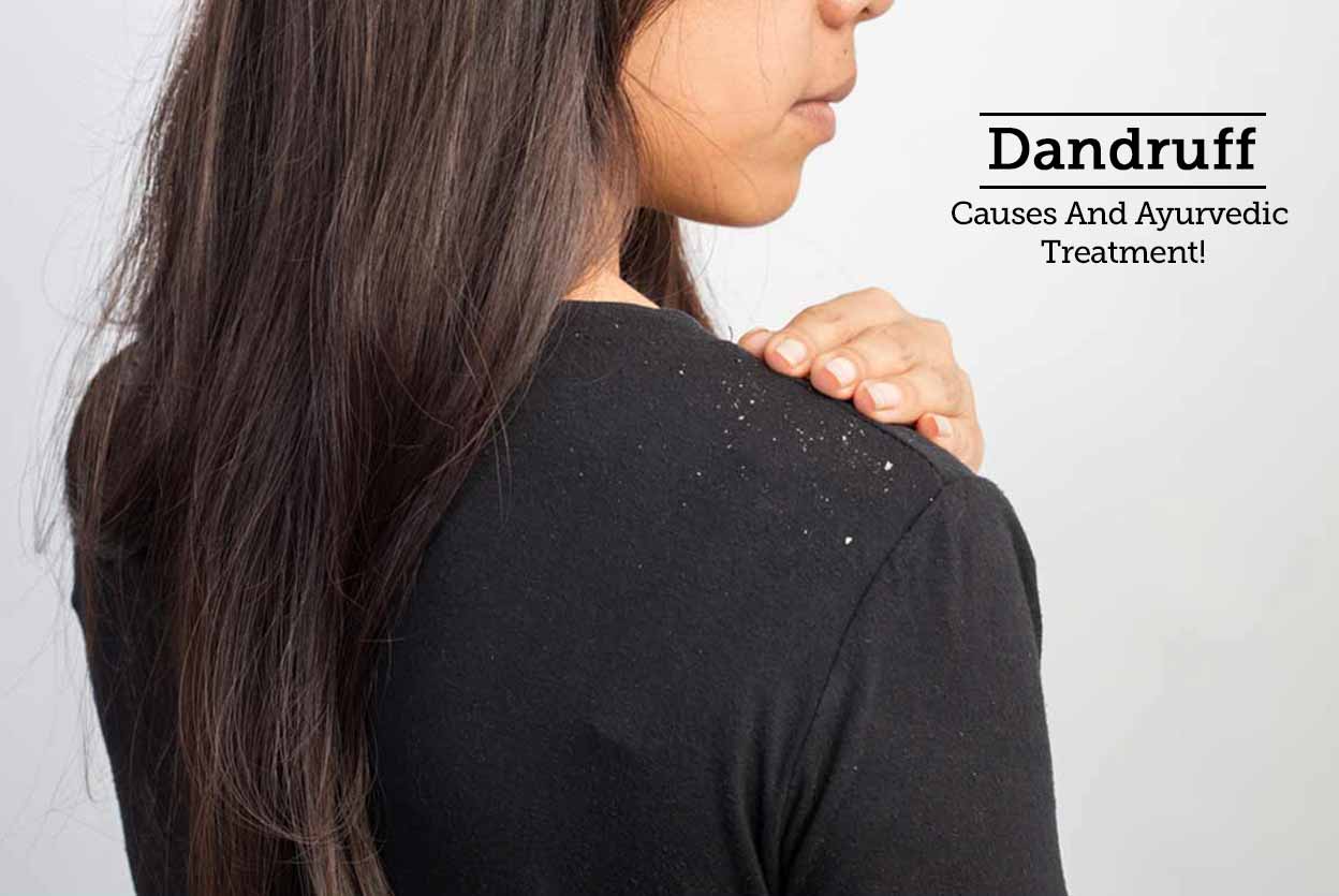 Dandruff - Causes And Ayurvedic Treatment! - By Dr. Vihar Bidwai | Lybrate