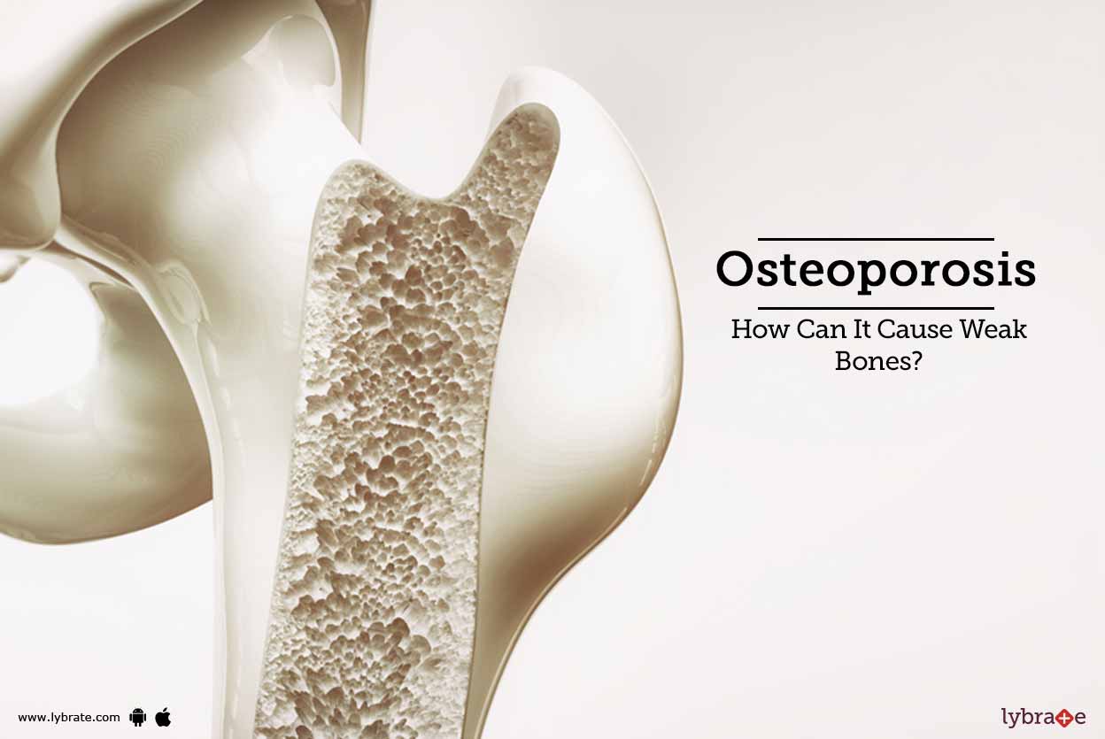 Osteoporosis - How Can It Cause Weak Bones? - By Dr. Amit Singhal | Lybrate