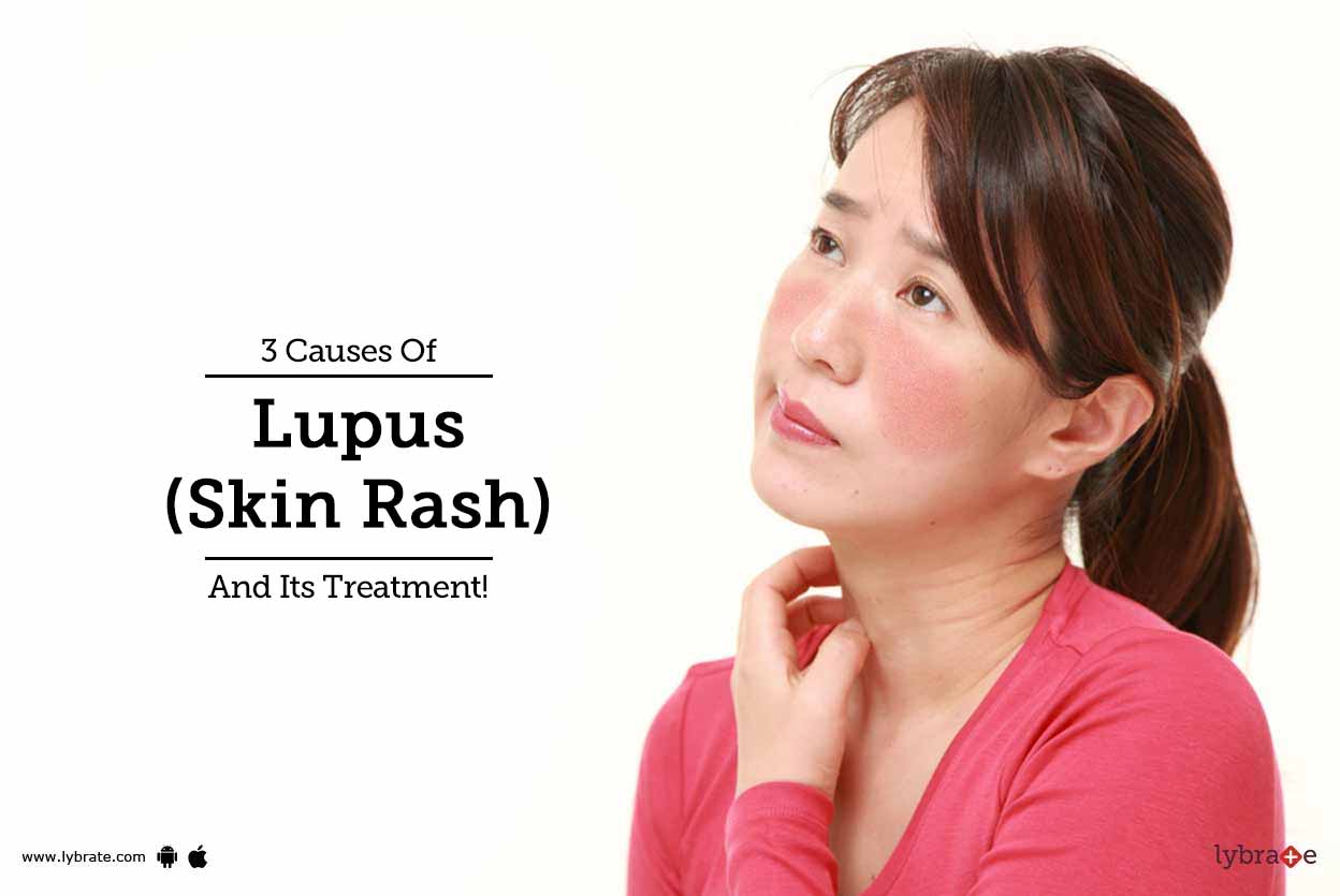 3 Causes Of Lupus (Skin Rash) And Its Treatment! - By Dr. Prashant ...